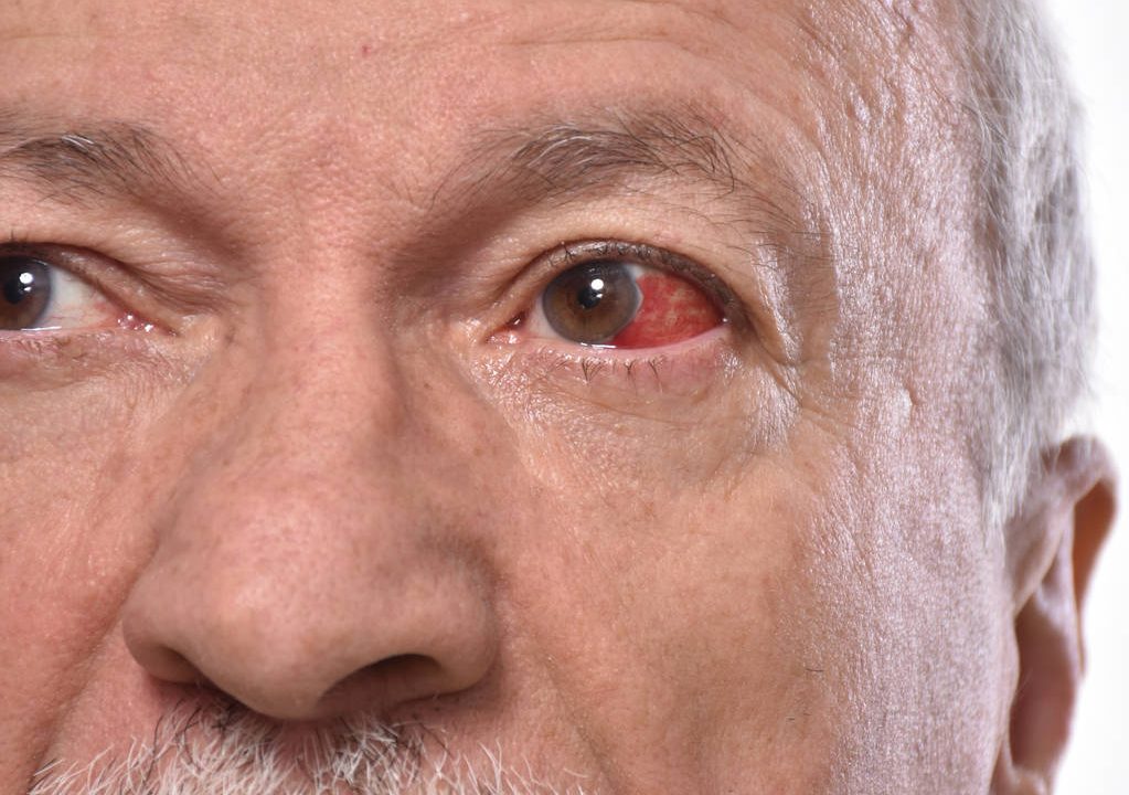 Dry Eye Disease | Malouf Eye