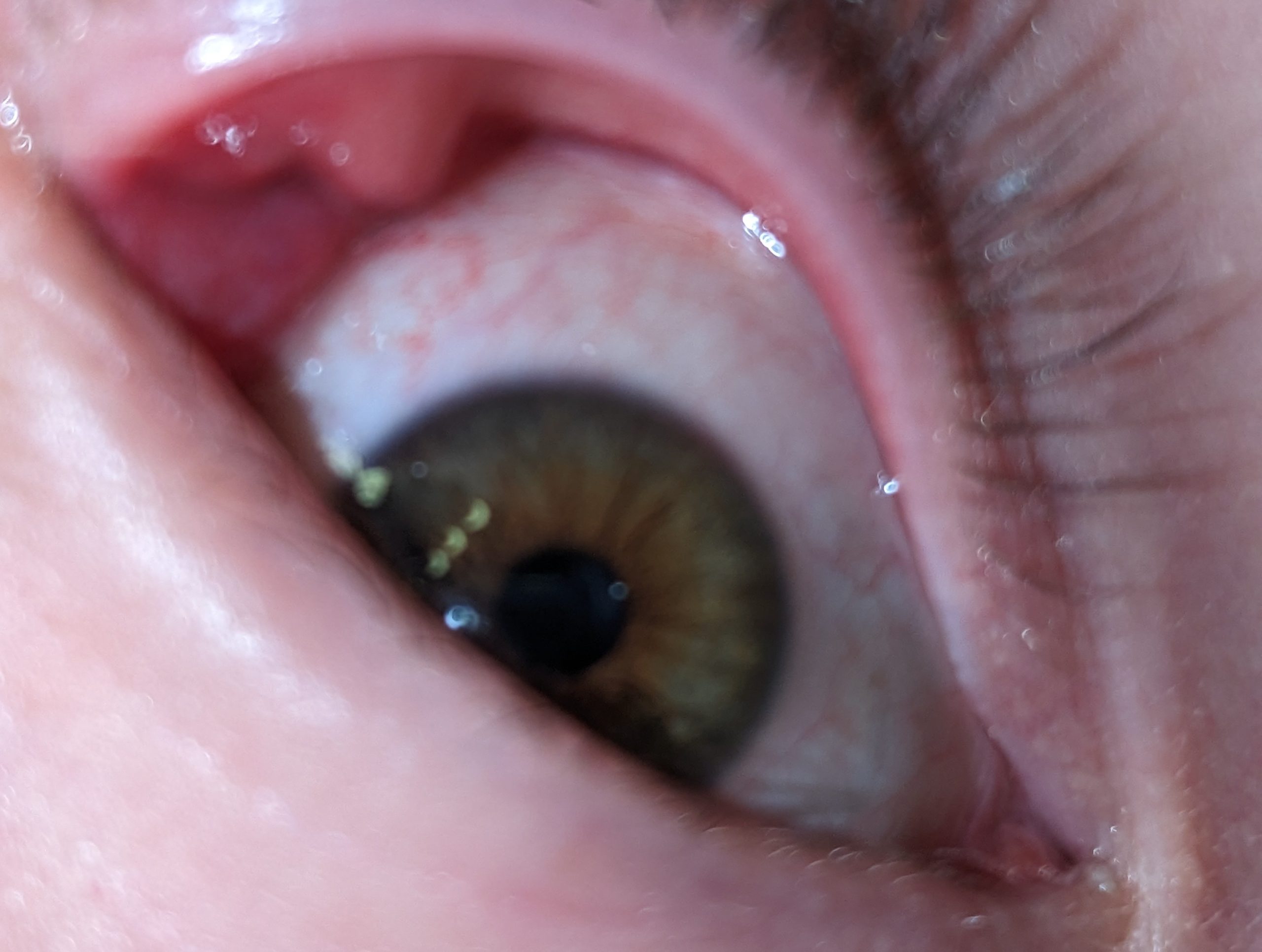 Can a Stye be Surgically Removed? | Malouf Eye